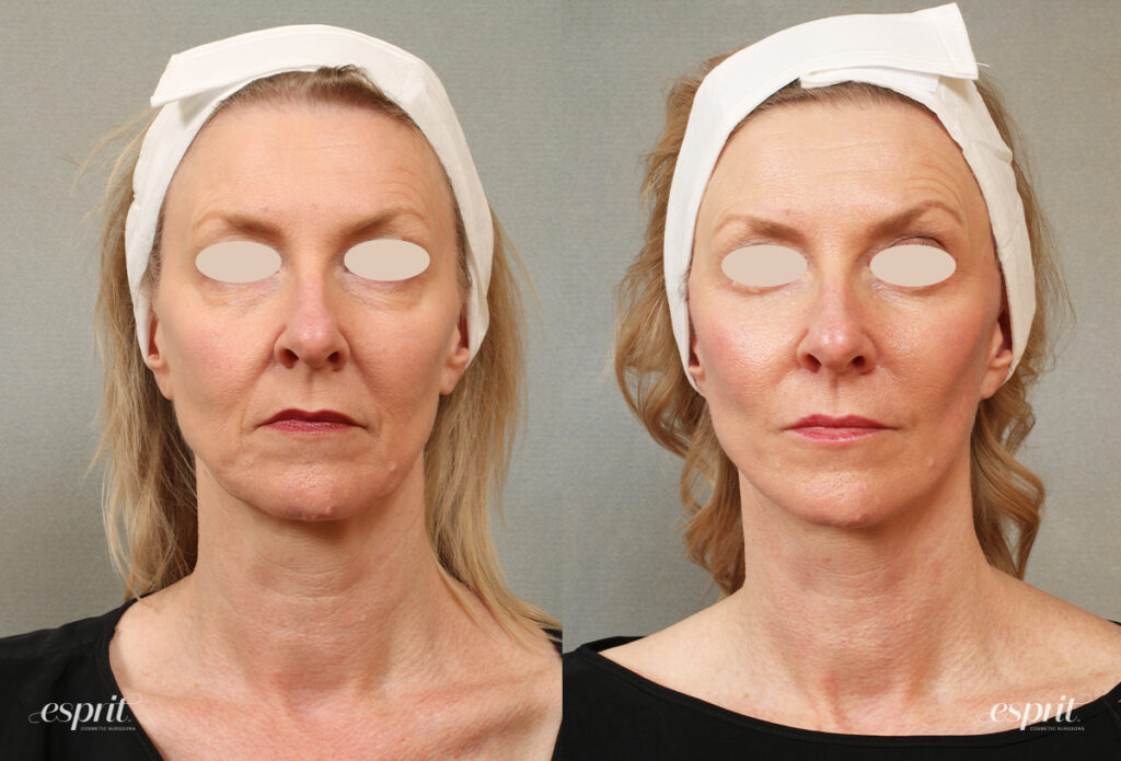 An Introduction to Facelifts and Neck Lifts | Esprit®